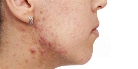 پوستی که هم لک دارد هم جوش فعال آکادمی احسان حسنانی