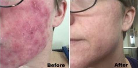 Red Light Therapy Acne Scars Before And After