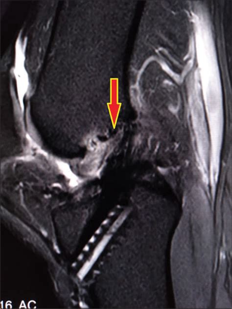 The Inverted Cyclops Lesion A Case Report Journal Of Arthroscopic