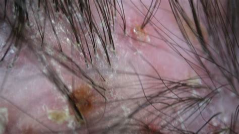Scalp Folliculitis Hair Loss