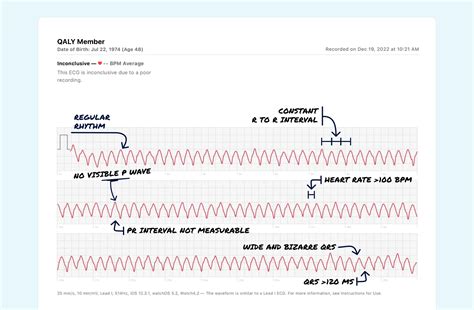Supraventricular Tachycardia Sustained Vs Ventricular Tachycardia