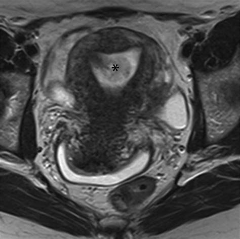 Endometrial Polyp Axial T 2 Weighted Magnetic Resonance Image From