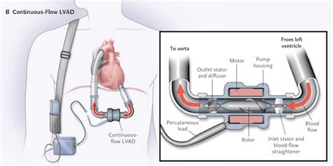 Continuous Flow Lvad Rebel Em Emergency Medicine Blog