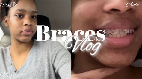 I Got Braces Braces Vlog My Experience Athenna Youtube