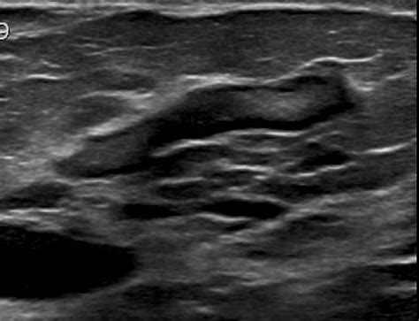 Mammary Duct Ectasia Radiology Reference Article