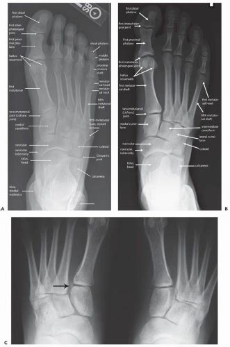 Tarsal Bones X Ray Anatomy