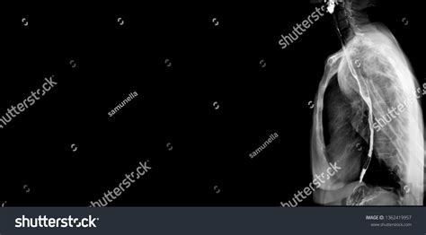 Esophagram Barium Swallow Lateral View Xray Stock Illustration 1362419957 Shutterstock
