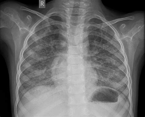 Pneumonitis Noted With Involvement Of Both Lungs In The Form Of Diffuse Download Scientific