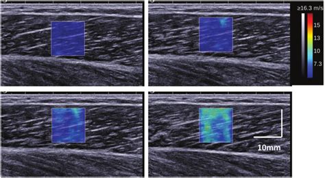 Typical Examples Of Muscle Shear Elastic Modulus Measured By Ultrasonic Download Scientific