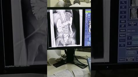 Loopogram Fluoroscopy Xray Radiology Youtube