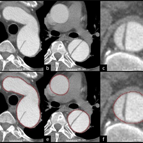 Examples Of Automatic Segmentations Of 2d V Net Blue And V Net
