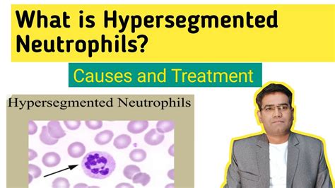 What Is Hyper Segmented Neutrophil Explained In Hindi Causes And