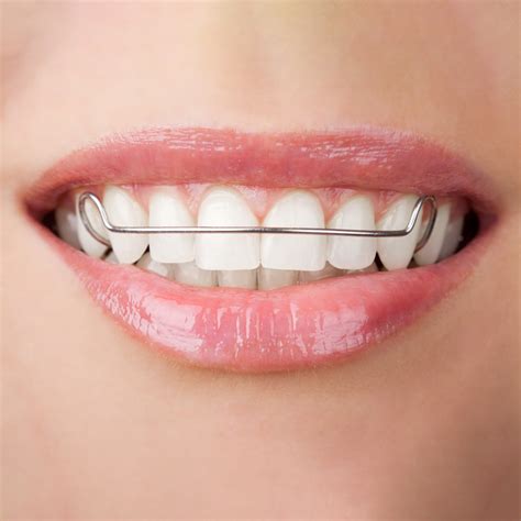 Removable Retainers Risinger Orthodontics