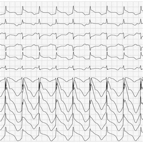 Ecg After 25 H Showed Marked St Segment Elevation In Leads V1v6 I Download Scientific