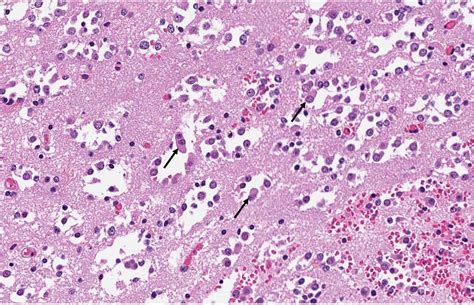 Pathology Outlines Multinodular And Vacuolating Neuronal Tumor Mvnt