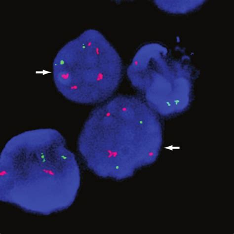 Pdf Cytogenetic Variation Of B Lymphoblastic Leukemia With