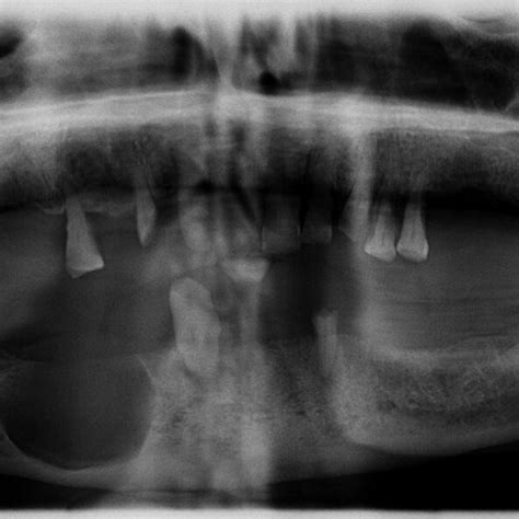 Figure No 2 Panorama X Ray Panorama X Ray Download Scientific Diagram