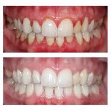 Healthy Gums Vs Unhealthy Gums