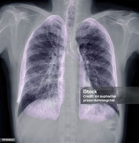 가슴 X 선 또는 폐의 3d 렌더링과 인간의 가슴의 X 선 이미지 X 레이에 대한 스톡 사진 및 기타 이미지 X 레이 간질성폐렴 건강 검진 Istock