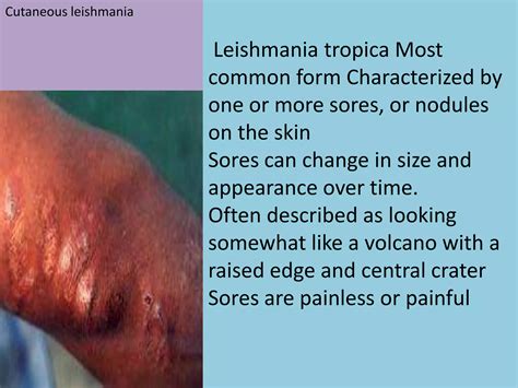 Leishmaniasis Pptx