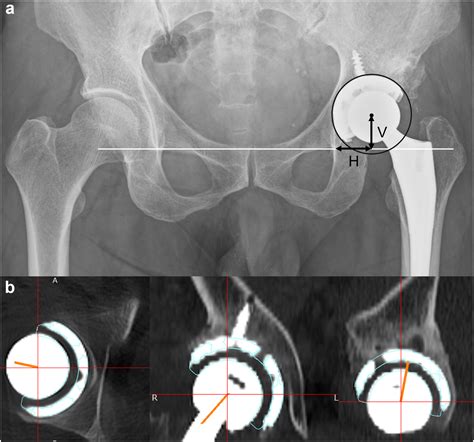 Robotic Armassisted System Improved Accuracy Of Cup Position And Orientation In Cementless
