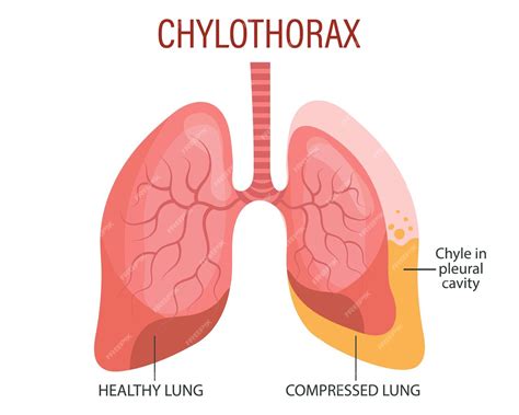Premium Vector Chylothorax Lung Diseases Healthcare Medical