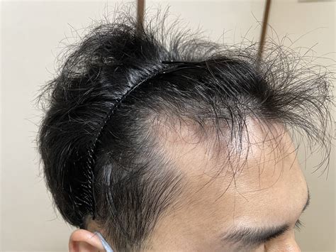 M字の薄毛も改善出来ます 薄毛AGAの発毛サロンならスーパースカルプ発毛センター鹿児島中央店へ
