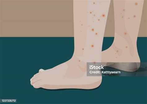 모기에 물린 아픈 빨간 반점 흉터 및 병변을 가진 아이의 다리 뎅기열에 대한 스톡 벡터 아트 및 기타 이미지 뎅기열 아이 빨강 Istock