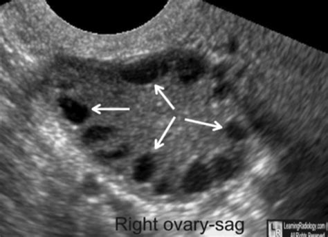 GYN Final Exam Flashcards Quizlet GYN Final Exam Flashcards Quizlet
