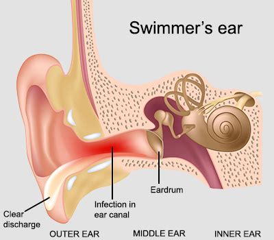 Swimmers Ear Otitis Externa Symptoms And Treatment Healthdirect