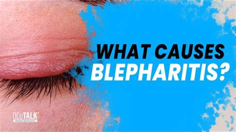 What Causes Blepharitis Dr Hosein Explains Ocusoft Inc