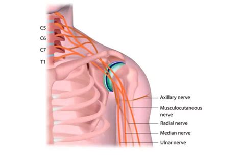 Understanding Brachial Plexus Neuropathy An Overview Of Parsonage