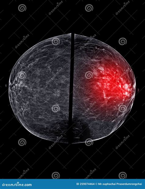 X Ray Digital Mammogram Or Mammography Of Both Side Breast Showing
