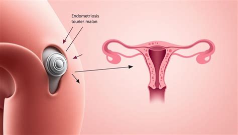 Implanon And Endometriosis Risk What To Know