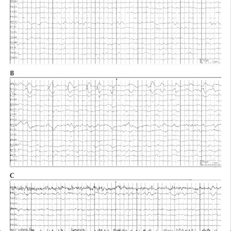 A Eeg Before Noxious Stimulation There Is Diffuse Theta Activity