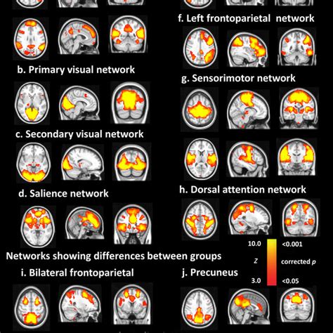 Differences Between Groups In Functional Connectivity Of Resting State