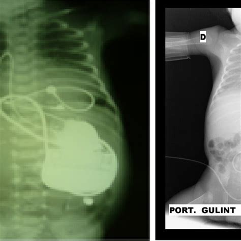 Case 1 Ecg After Birth—isolated Congenital Complete Atrioventricular