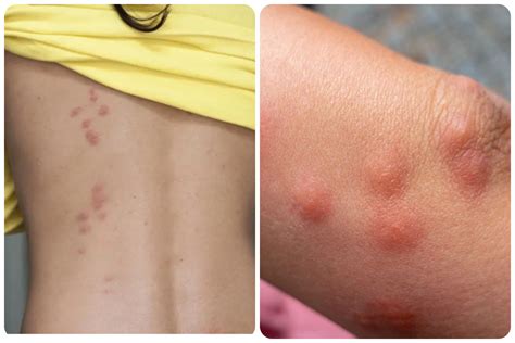 Cómo Son Las Picaduras De Chinches Y Como Diferenciarlas De Otros Parásitos Externos