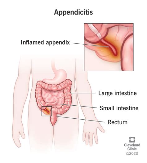 Appendix Diagram Location Ruptured Appendix Causes Symptoms