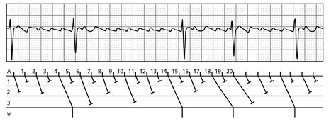 14 Even Ratios Of Atrioventricular Conduction 41