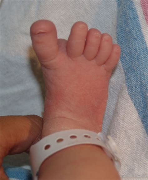 Sandal Toe Deformity