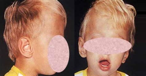 Macrocephaly Causes Symptoms And Treatment