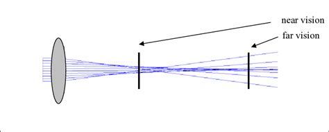 Example Of Multifocal Refractive IOL Optical Path Download Scientific Diagram