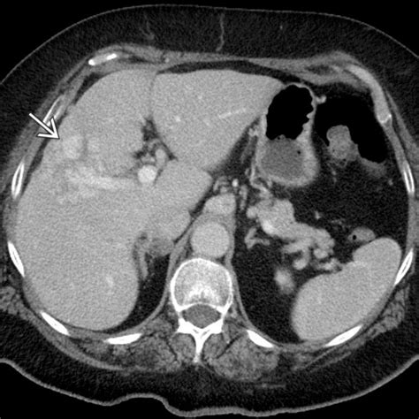 Intrahepatic Cholangiocarcinoma Basicmedical Key