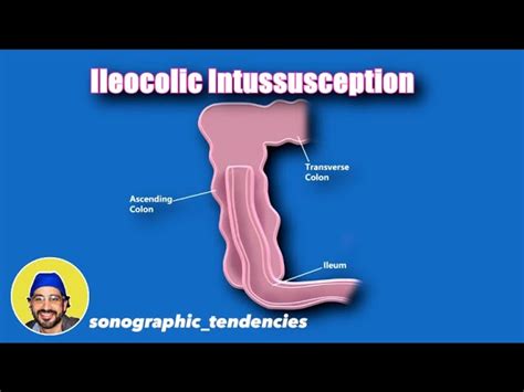 Intussusception