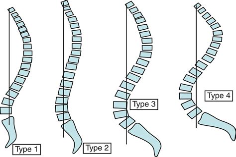 Lumbar Total Disc Arthroplasty Clinical Tree