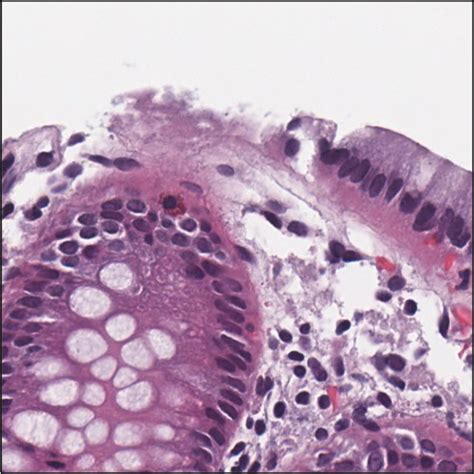 Pdf Semantic Segmentation Of Colon Glands In Inflammatory Bowel Disease Biopsies