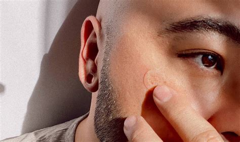 How To Make Pimples Less Noticeable