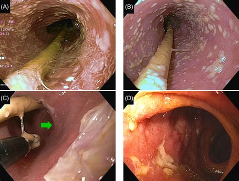 Inflammatory Bowel Diseaseassociated Digestive Disorders Clinical Tree