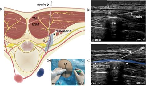 Schematic Illustration And Ultrasound Images Of Erector Spinae Plane Download Scientific